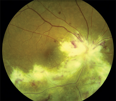 Retinal Physician | PentaVision