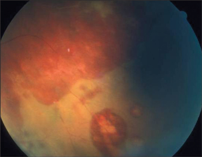 Retinal Physician | PentaVision