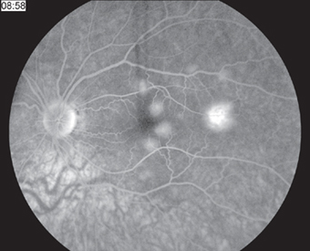 Retinal Physician | PentaVision