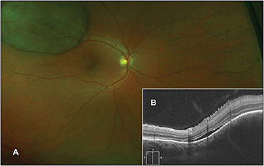 Retinal Physician | PentaVision