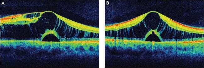 Retinal Physician | PentaVision