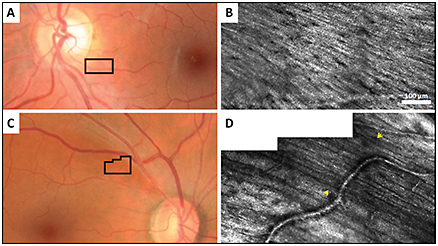 Retinal Physician | PentaVision