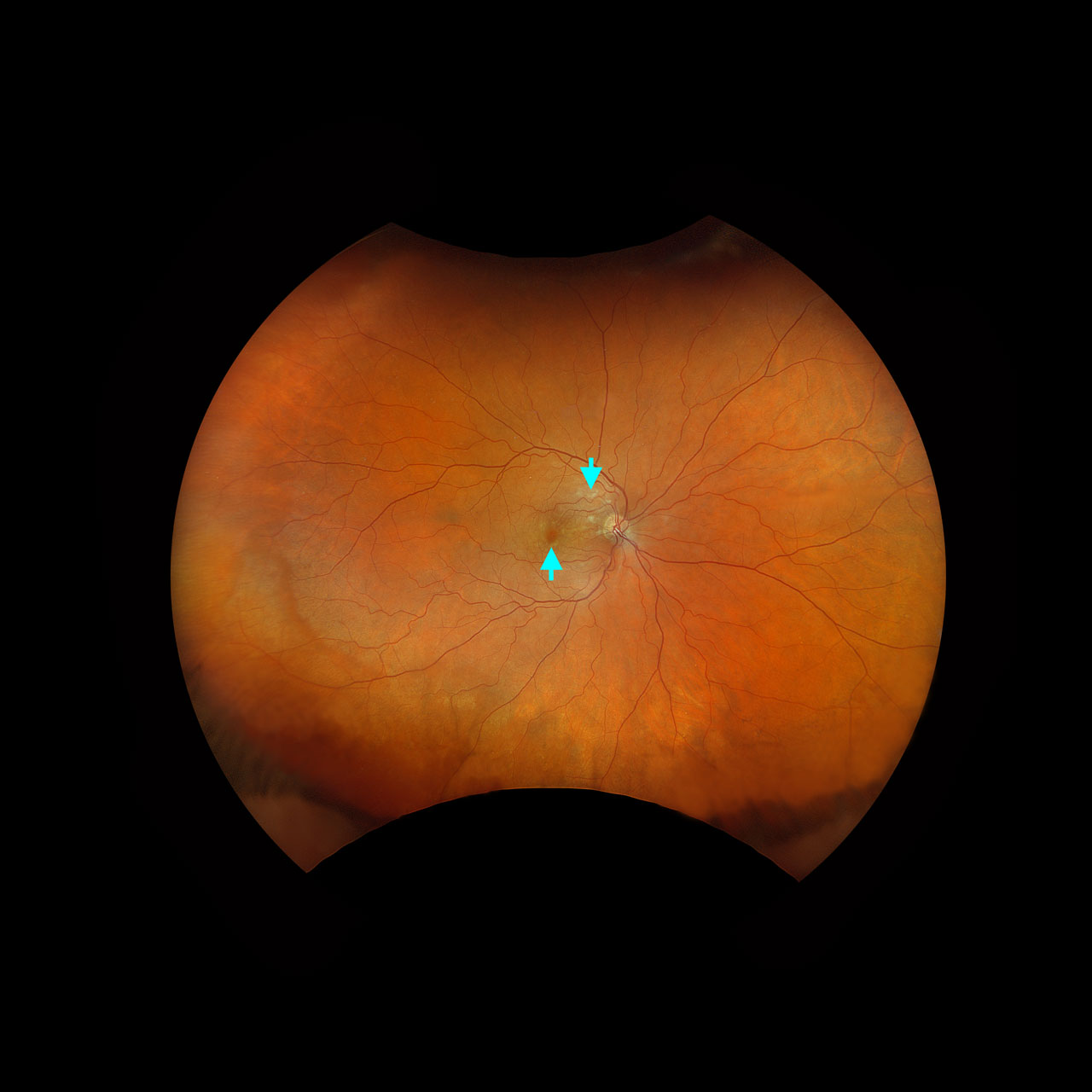 Ultra-Widefield Image of the Month | Retinal Physician