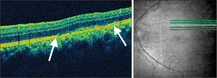 Retinal Physician | PentaVision
