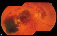 Retinal Physician | PentaVision