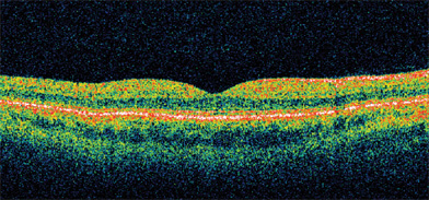 Retinal Physician | PentaVision