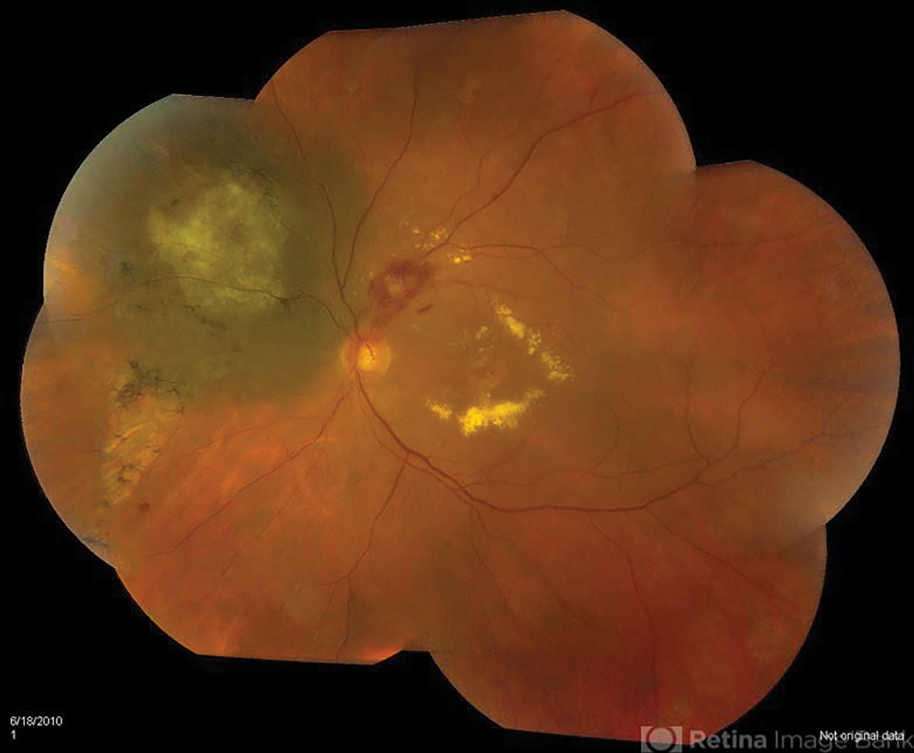 History and Current Directions of the DRCR Retina Network | Retinal ...