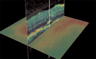Retinal Physician | PentaVision