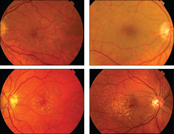 Retinal Physician | PentaVision