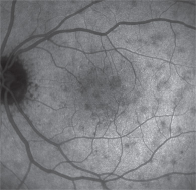 Retinal Physician | PentaVision