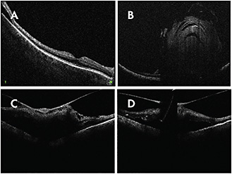 Retinal Physician | PentaVision