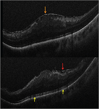 Retinal Physician | PentaVision