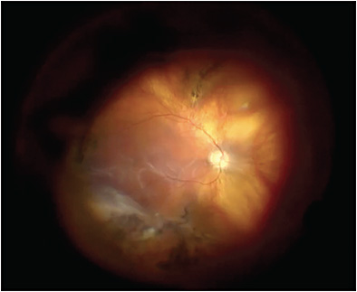 Retinal Physician | PentaVision