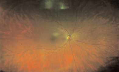Retinal Physician | PentaVision