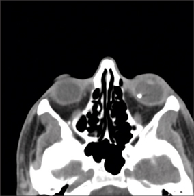 Retinal Physician | PentaVision