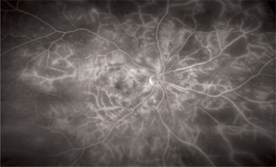 Retinal Physician | PentaVision