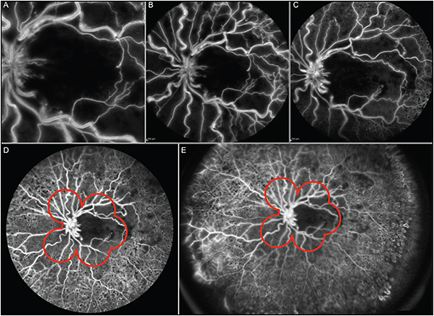 Retinal Physician | PentaVision