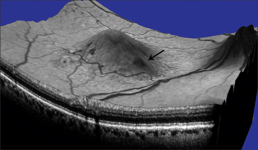 Retinal Physician | PentaVision