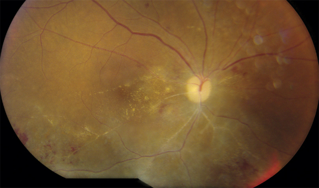 Retinal Physician | PentaVision