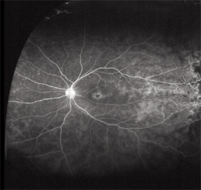 Retinal Physician | PentaVision