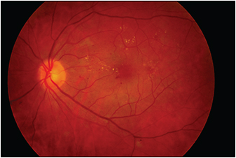 Retinal Physician | PentaVision