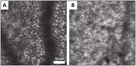 Retinal Physician | PentaVision
