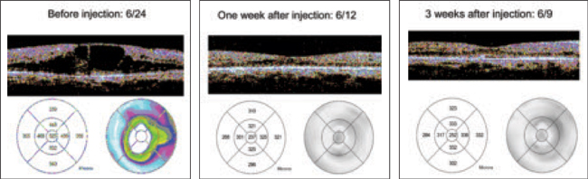 Retinal Physician | PentaVision