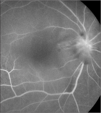 Retinal Physician | PentaVision