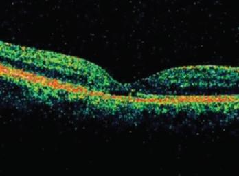 Retinal Physician | PentaVision