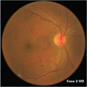 Retinal Physician | PentaVision