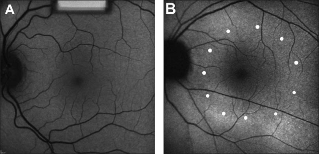 Retinal Physician | PentaVision