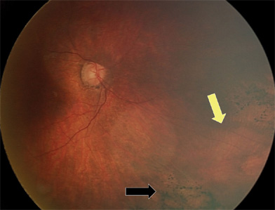 Retinal Physician | PentaVision