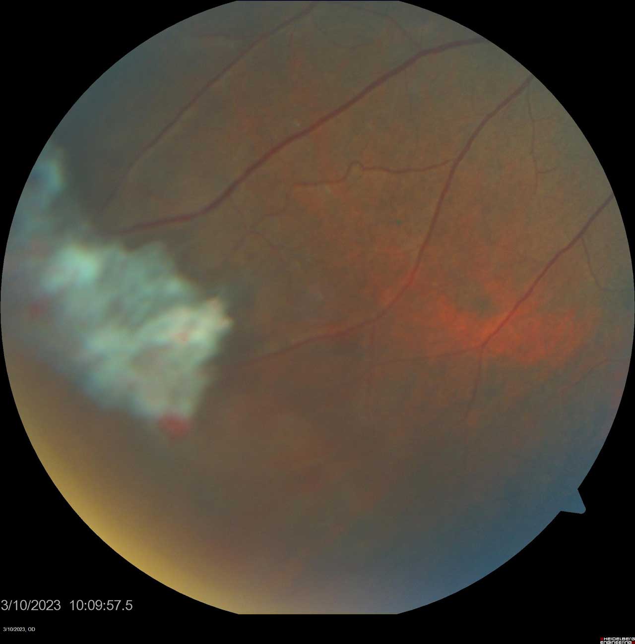 New Treatments for Sickle Cell Disease | Retinal Physician