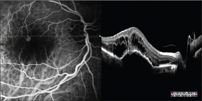 Retinal Physician | PentaVision