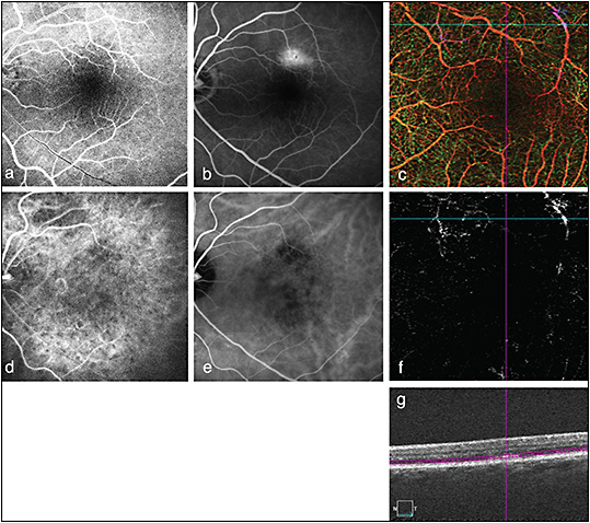 Retinal Physician | PentaVision