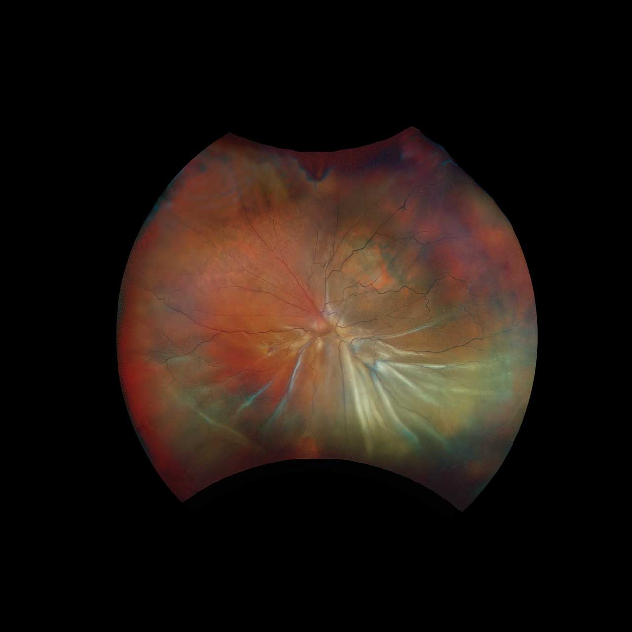 Ultra-Widefield Image of the Month | Retinal Physician