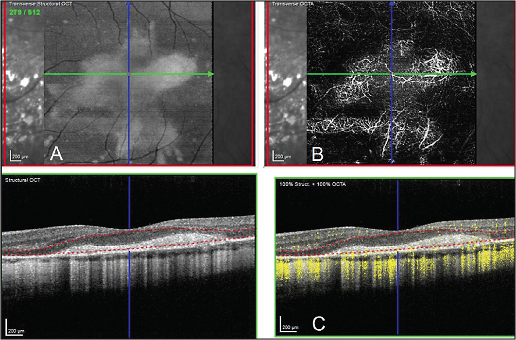 Retinal Physician | PentaVision