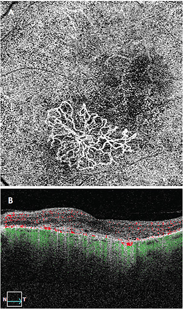 Retinal Physician | PentaVision
