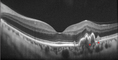 Retinal Physician | PentaVision