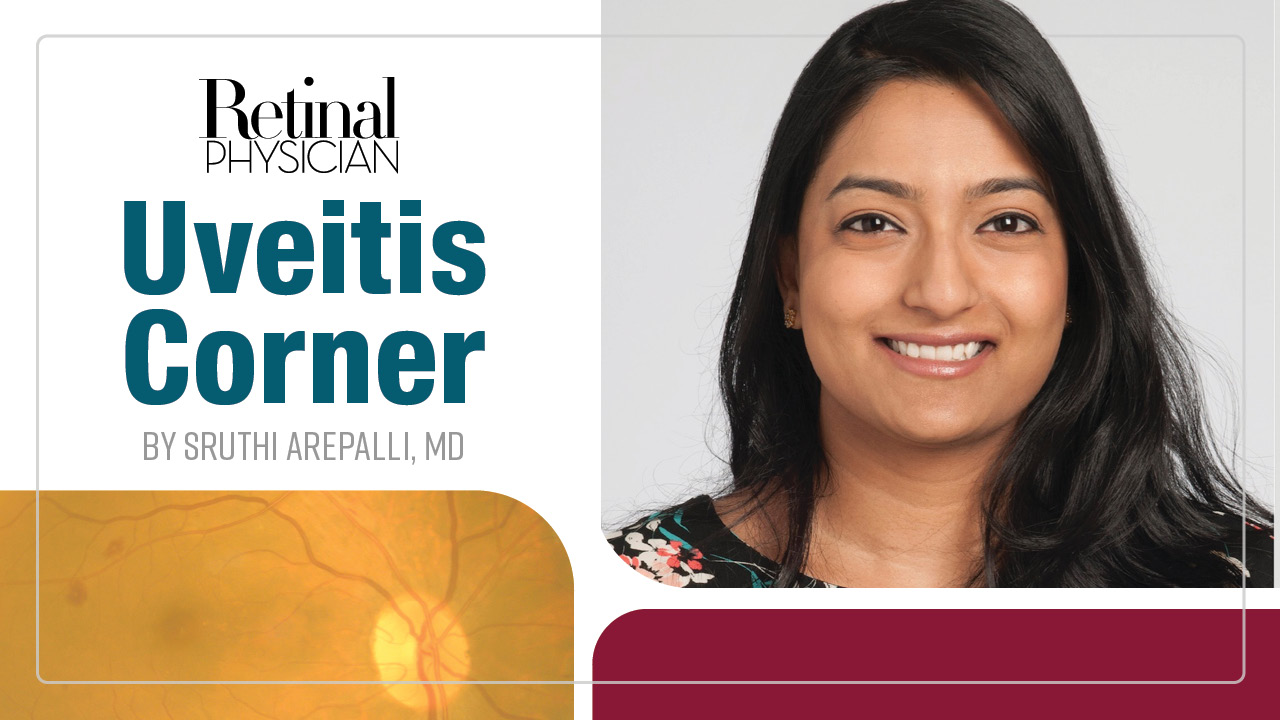 An Update on Local Steroids for Uveitis | Retinal Physician