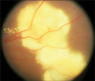 Retinal Physician | PentaVision