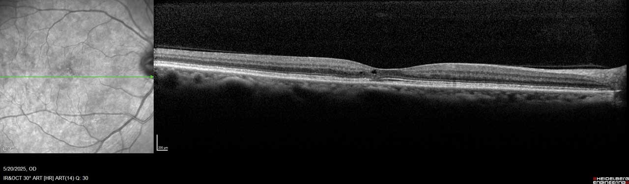 Navigating MacTel From Diagnosis to Therapy | Retinal Physician