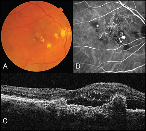 Retinal Physician | PentaVision