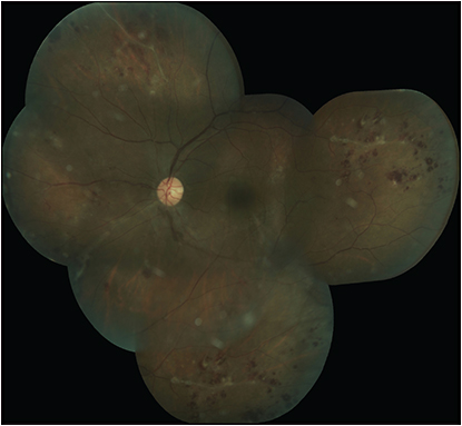 Retinal Physician | PentaVision