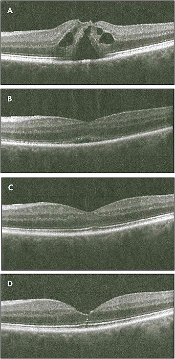 Retinal Physician | PentaVision