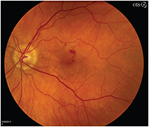 Retinal Physician | PentaVision