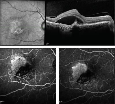 Retinal Physician | PentaVision