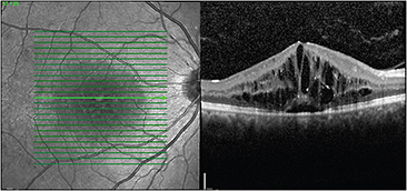 Retinal Physician | PentaVision