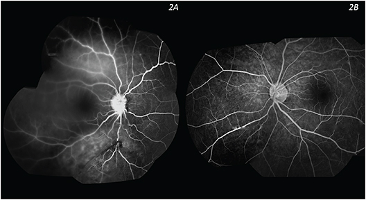 Retinal Physician | PentaVision