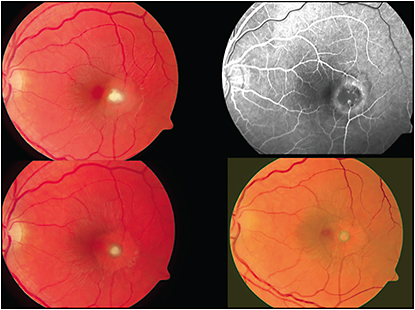 Retinal Physician | PentaVision